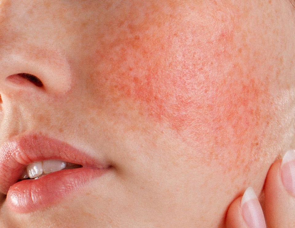 Dermatologist’s Guide to Rosacea: Top Do's & Don'ts – Prequel