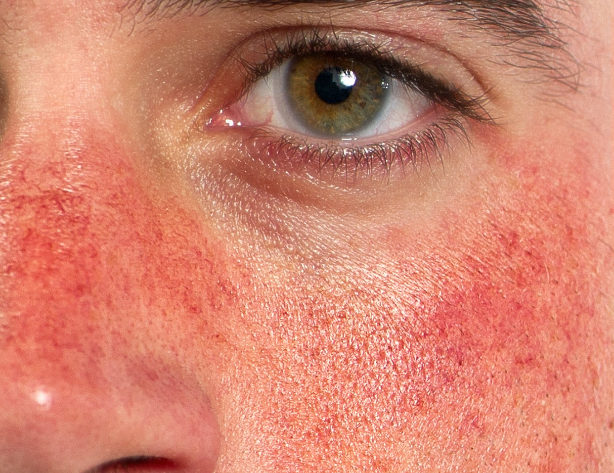 Top Skincare Ingredients That Help With Rosacea – Prequel